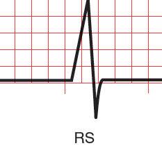 Eletrocardiograma (ECG): o que é e como interpretar as ondas - Sanar ...