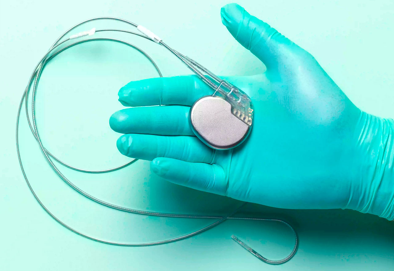 Marcapassos: o que são, importância e quando são indicados - Sanarmed
