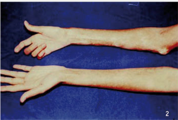 Esclerose Sistêmica (ES): definição e fisiopatologia - Sanar Medicina