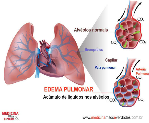Sepse: saiba TUDO sobre a Infecção Generalizada - Sanarmed