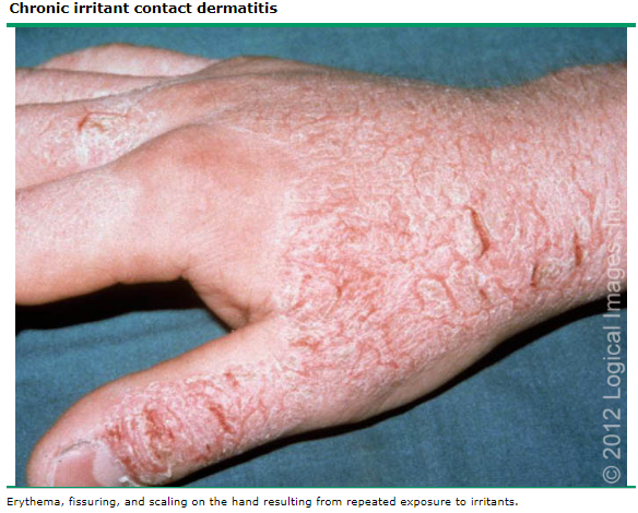 Dermatites Eczematosas: o que são e os principais tipos - Sanarmed